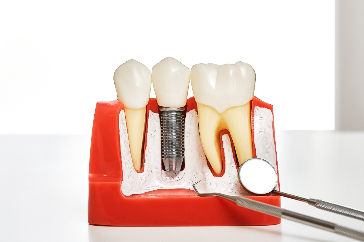 Key Signs You May Need Dental Implants | Oral Health Guide